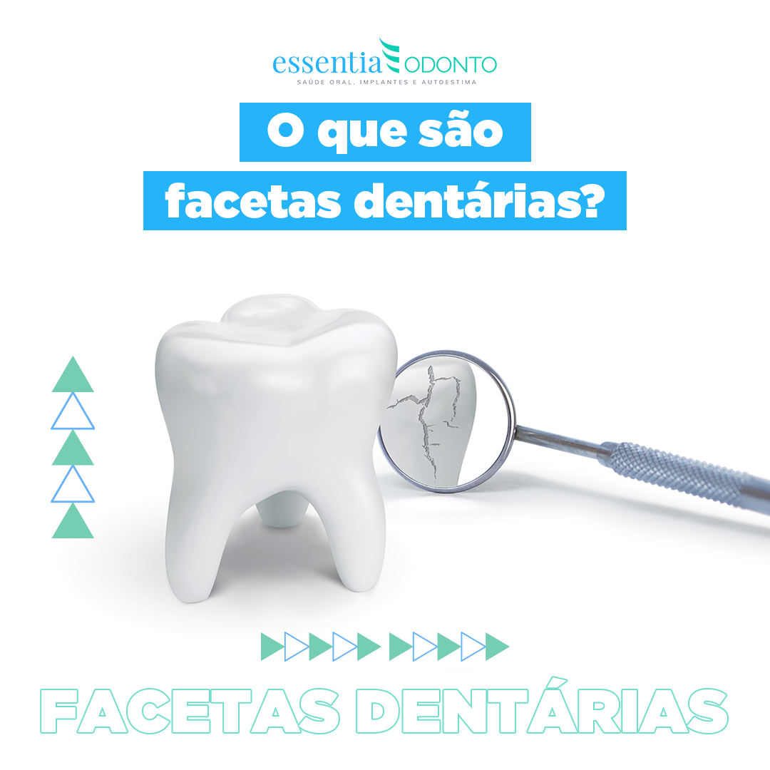 O que são facetas dentárias? - Blog -Essentia Odonto